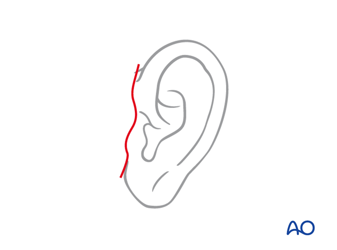 Coronal approach (including craniotomy)