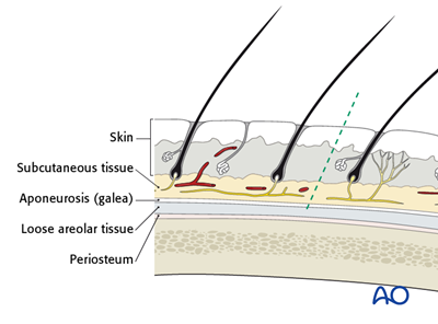 Coronal approach (including craniotomy)