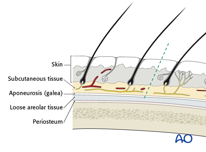 Coronal approach (including craniotomy)