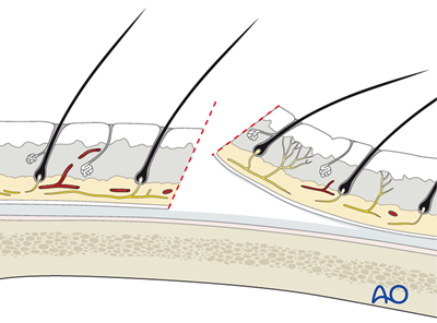 Coronal approach (including craniotomy)