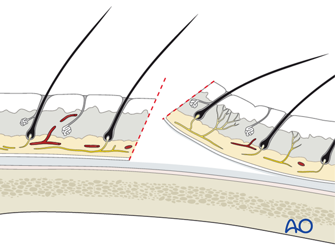 Coronal approach (including craniotomy)