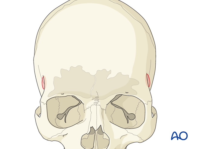 Coronal approach (including craniotomy)