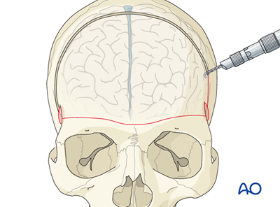 Coronal approach (including craniotomy)