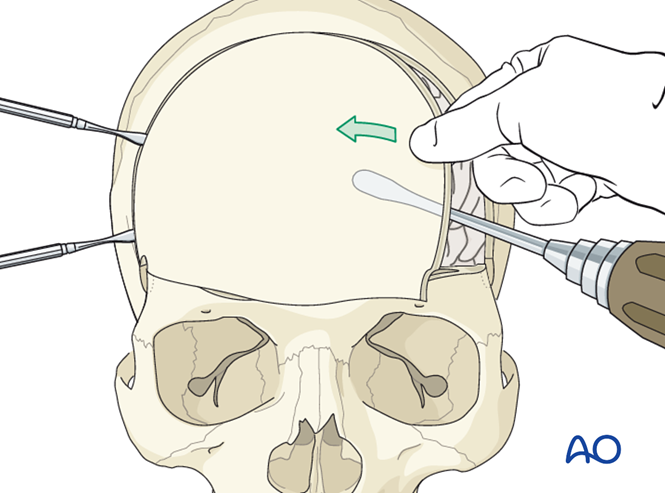 Coronal approach (including craniotomy)