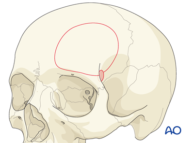 Coronal approach (including craniotomy)