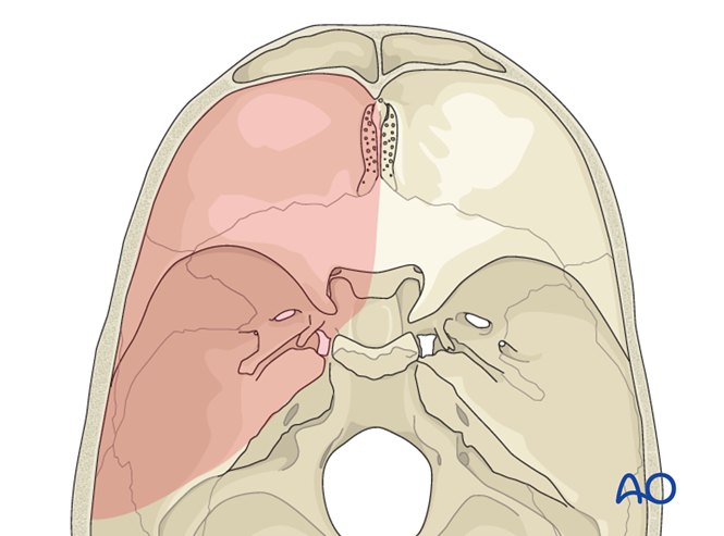 Lateral skull base approach (“middle fossa approach”)