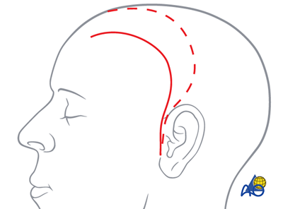 Lateral skull base approach (“middle fossa approach”)