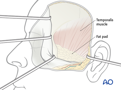 Lateral skull base approach (“middle fossa approach”)