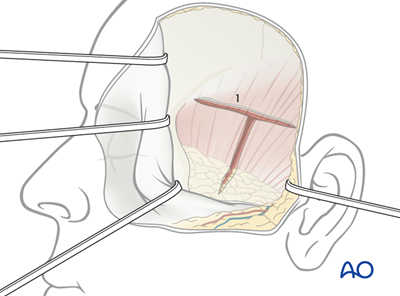 Lateral skull base approach (“middle fossa approach”)