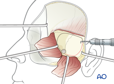 Lateral skull base approach (“middle fossa approach”)