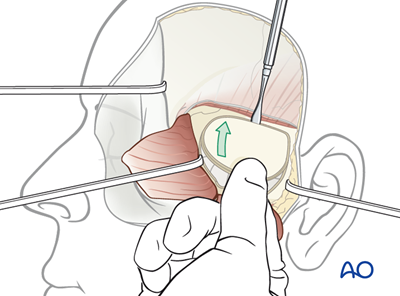 Lateral skull base approach (“middle fossa approach”)