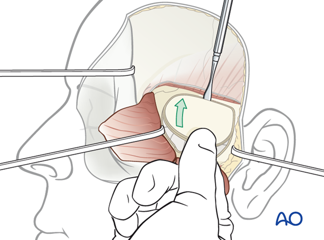 Lateral skull base approach (“middle fossa approach”)