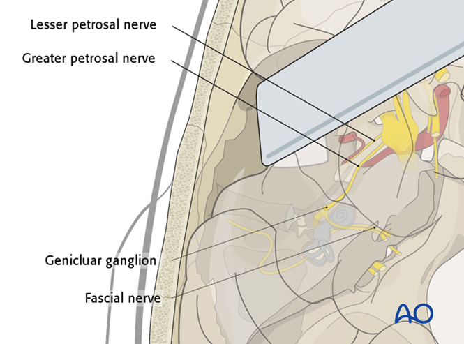 Lateral skull base approach (“middle fossa approach”)