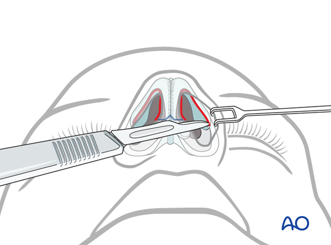 External rhinoplasty approach (open)