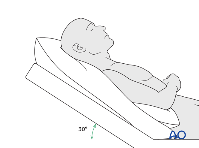 Cranialization for Frontal sinus fracture, posterior table
