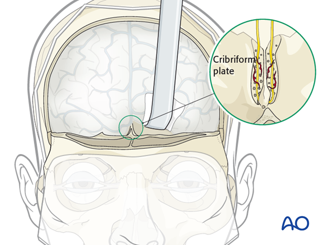 Extradural repair for Skull base fracture, anterior