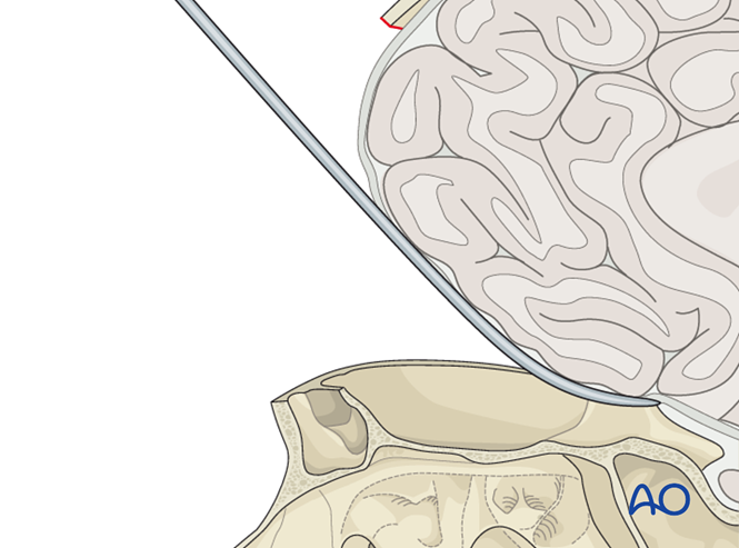 Extradural repair for Skull base fracture, anterior