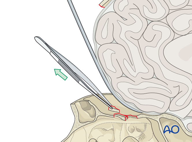 Extradural repair for Skull base fracture, anterior