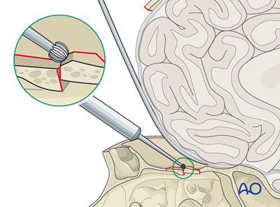 Extradural repair for Skull base fracture, anterior