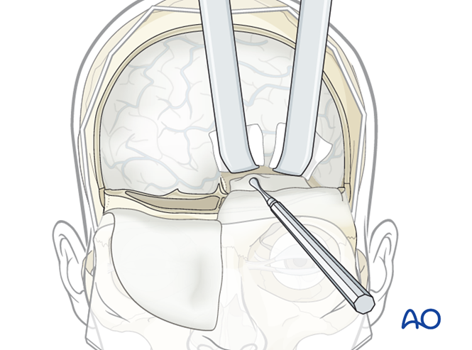 Extradural repair for Skull base fracture, anterior