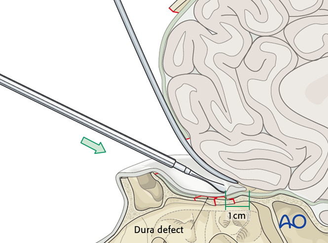Intradural repair for Skull base fracture, anterior