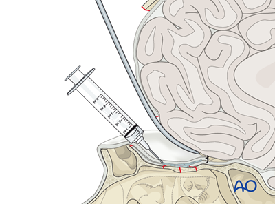Intradural repair for Skull base fracture, anterior