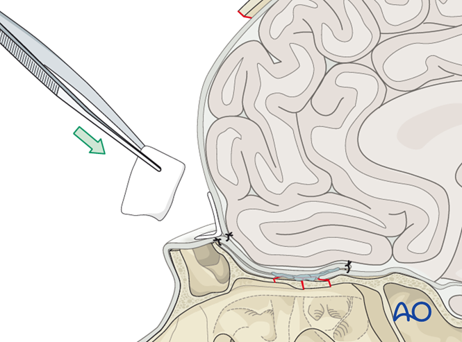 Intradural repair for Skull base fracture, anterior