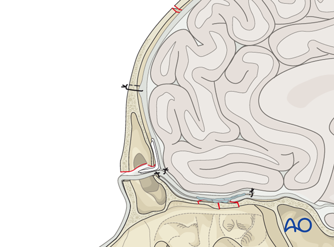 Extradural repair for Skull base fracture, anterior