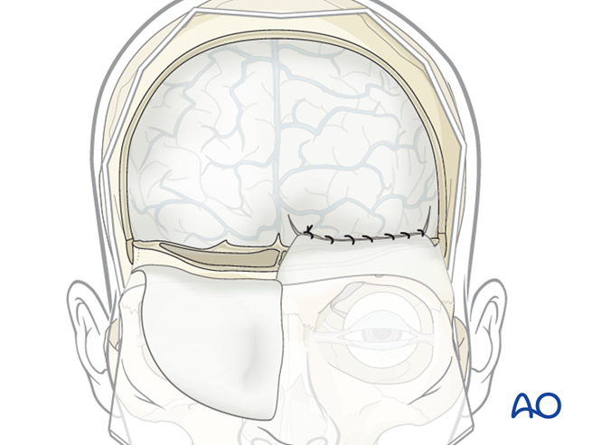 Intradural repair for Skull base fracture, anterior