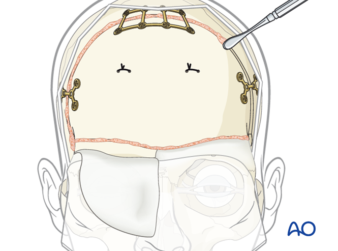Extradural repair for Skull base fracture, anterior