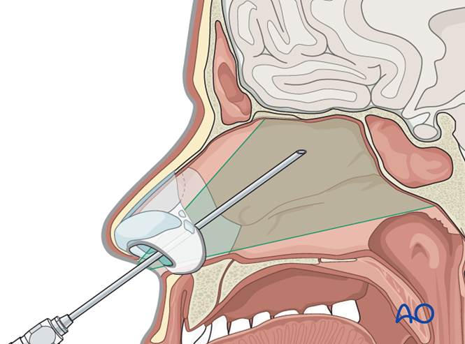 Endoscopic repair of CSF leak for Skull base fracture, central (anterior)