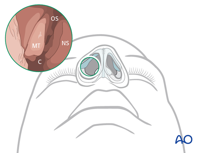Endoscopic repair of CSF leak for Skull base fracture, central (anterior)
