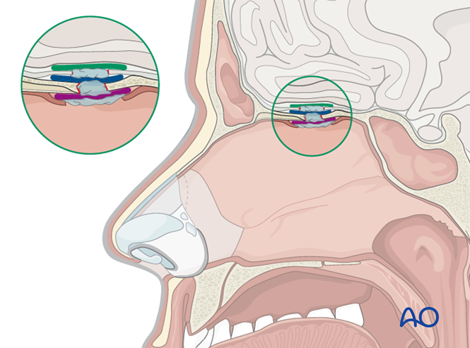 Endoscopic repair of CSF leak for Skull base fracture, central (anterior)