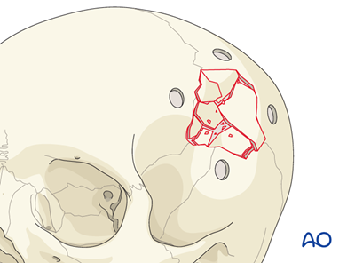 Treatment of depressed cranial vault fractures for Cranial vault fracture