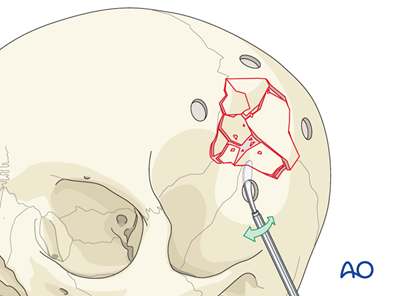 Treatment of depressed cranial vault fractures for Cranial vault fracture