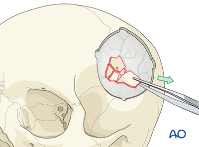 Treatment of depressed cranial vault fractures for Cranial vault fracture