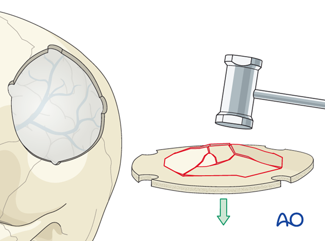 Treatment of depressed cranial vault fractures for Cranial vault fracture
