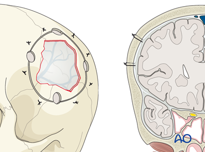 Treatment of depressed cranial vault fractures for Cranial vault fracture