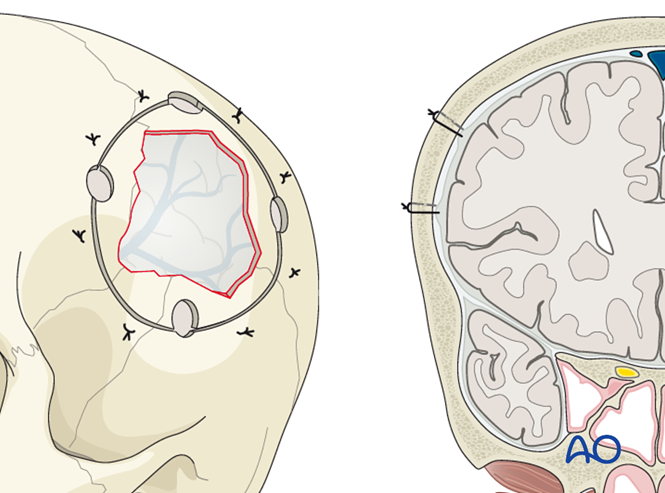 Treatment of depressed cranial vault fractures for Cranial vault fracture