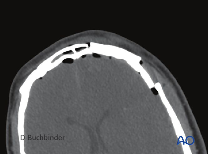 Cranial vault fracture