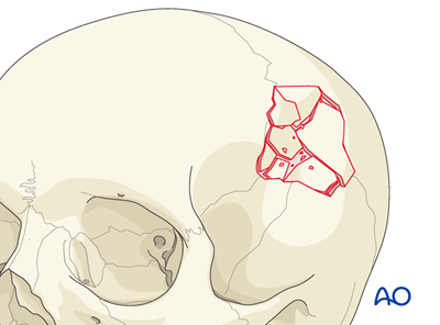 Cranial vault fracture