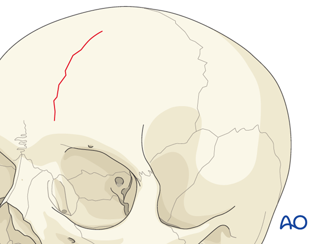 Cranial vault fracture