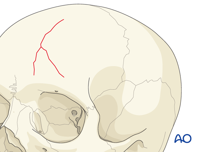 Cranial vault fracture