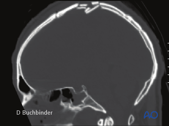 Cranial vault fracture