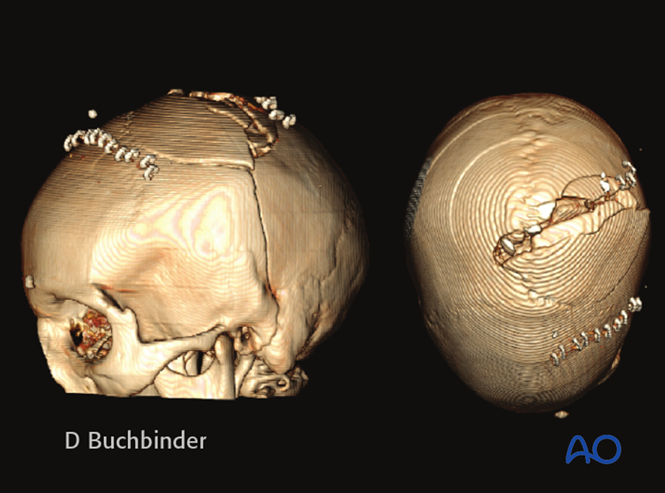 Cranial vault fracture