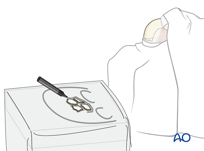 Cranialization for Frontal sinus fracture, posterior table