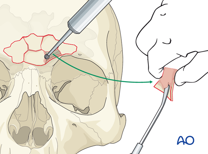 Open reduction internal fixation for Frontal sinus fracture, anterior table