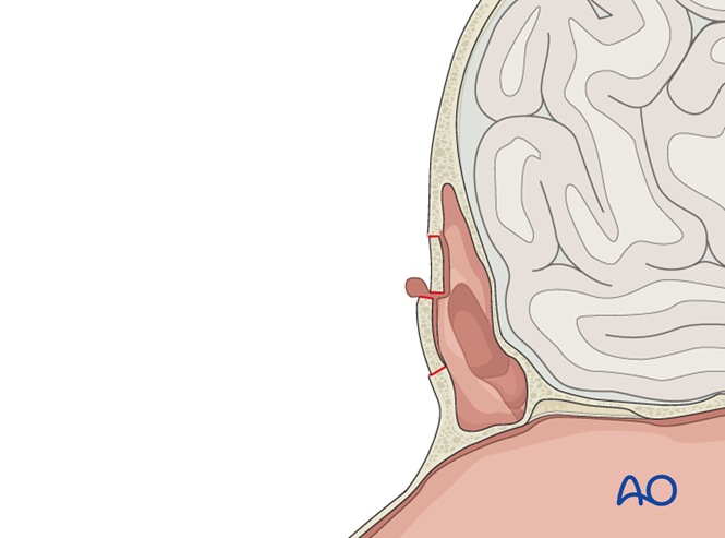 Open reduction internal fixation for Frontal sinus fracture, anterior table