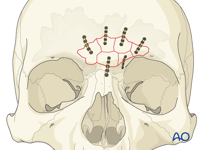 Open reduction internal fixation for Frontal sinus fracture, anterior table