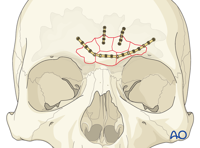 Open reduction internal fixation for Frontal sinus fracture, anterior table